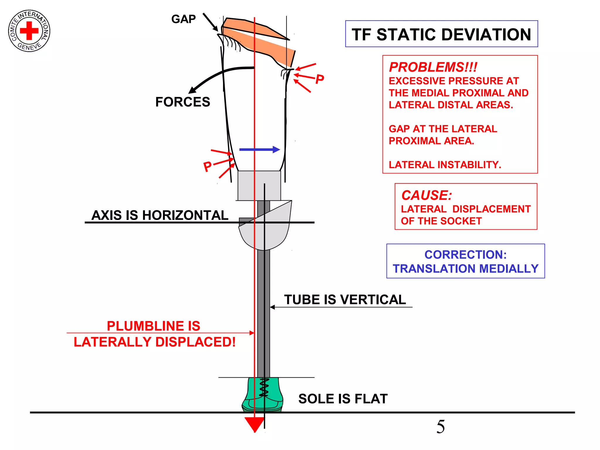 Transfemoral Static Alignment | PPT