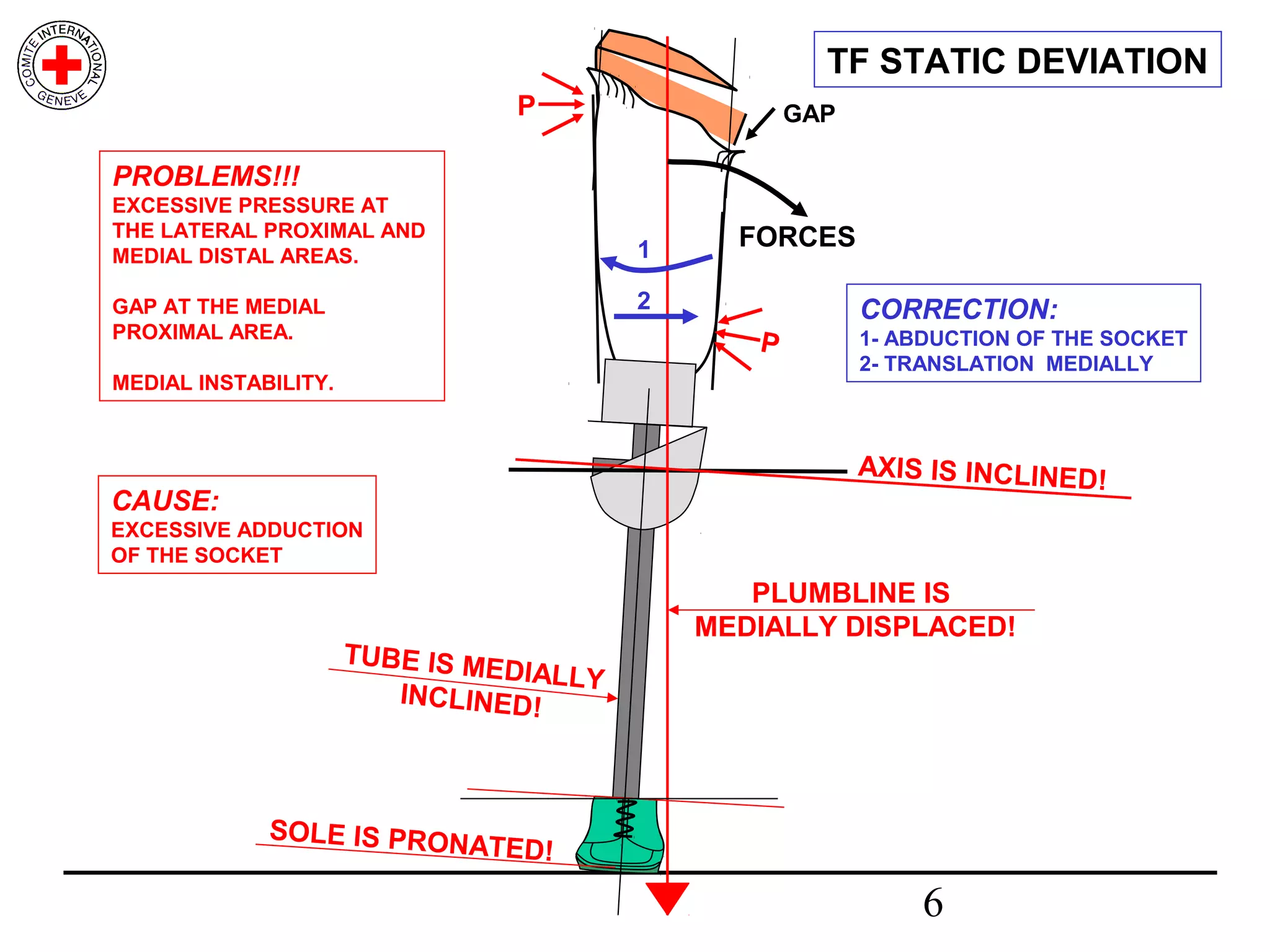 Transfemoral Static Alignment | PPT