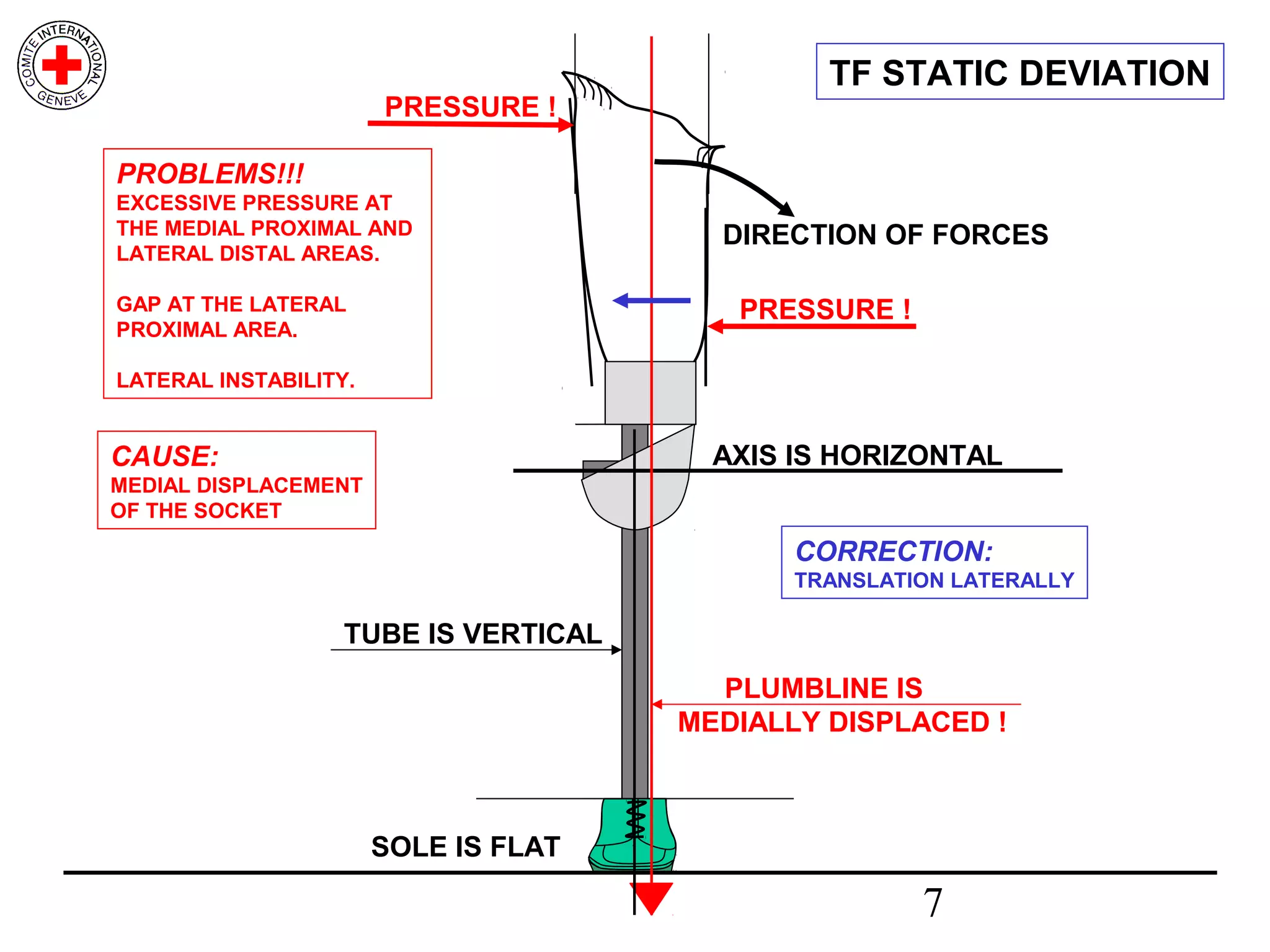 Transfemoral Static Alignment | PPT
