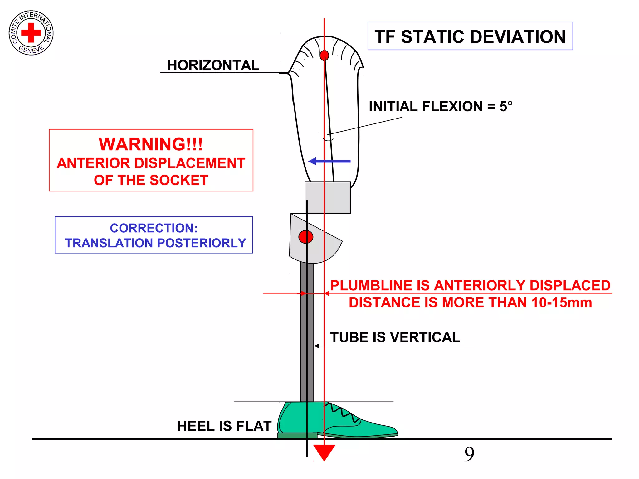 Transfemoral Static Alignment | PPT