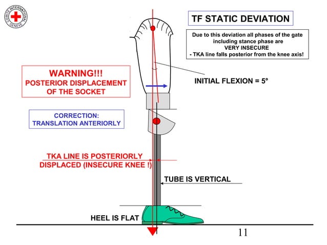 Transfemoral Static Alignment | PPT | Death, Injury, or Military ...