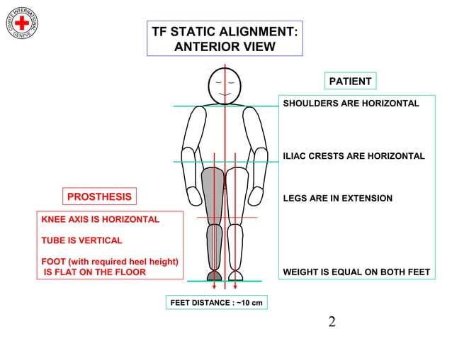 Transfemoral Static Alignment | PPT | Death, Injury, or Military ...