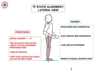 Transfemoral Static Alignment | PPT