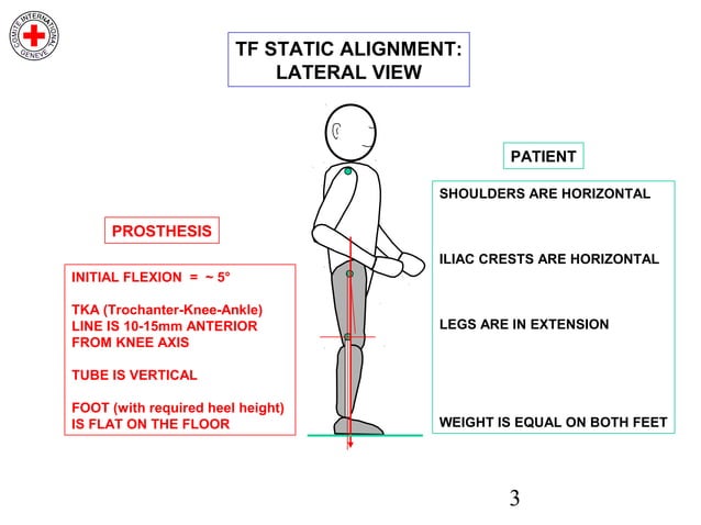Transfemoral Static Alignment | PPT | Death, Injury, or Military ...