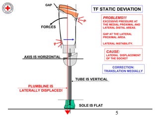 Transfemoral Static Alignment | PPT