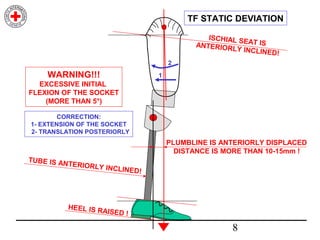 Transfemoral Static Alignment | PPT