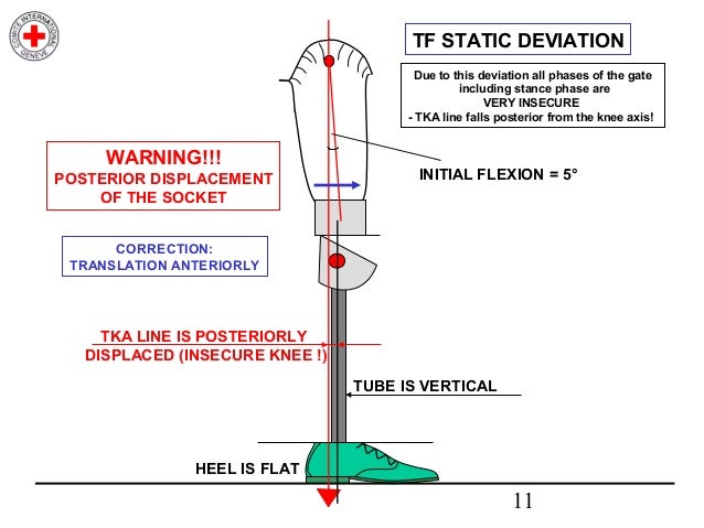 Transfemoral Static Alignment