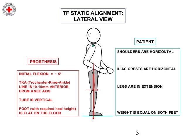 Transfemoral Static Alignment