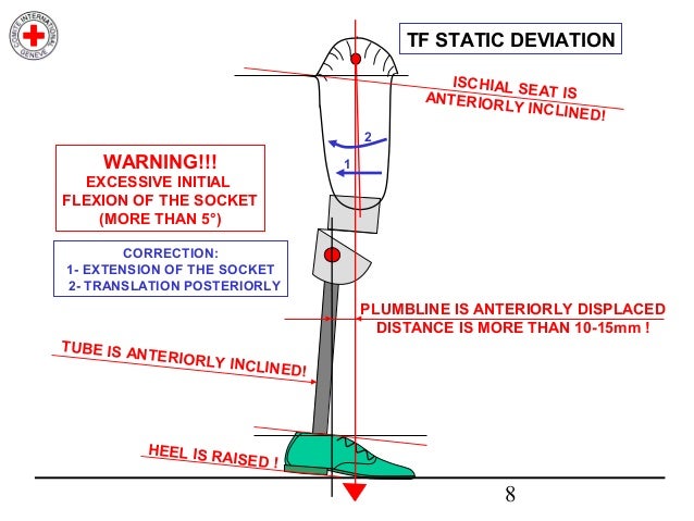 Transfemoral Static Alignment