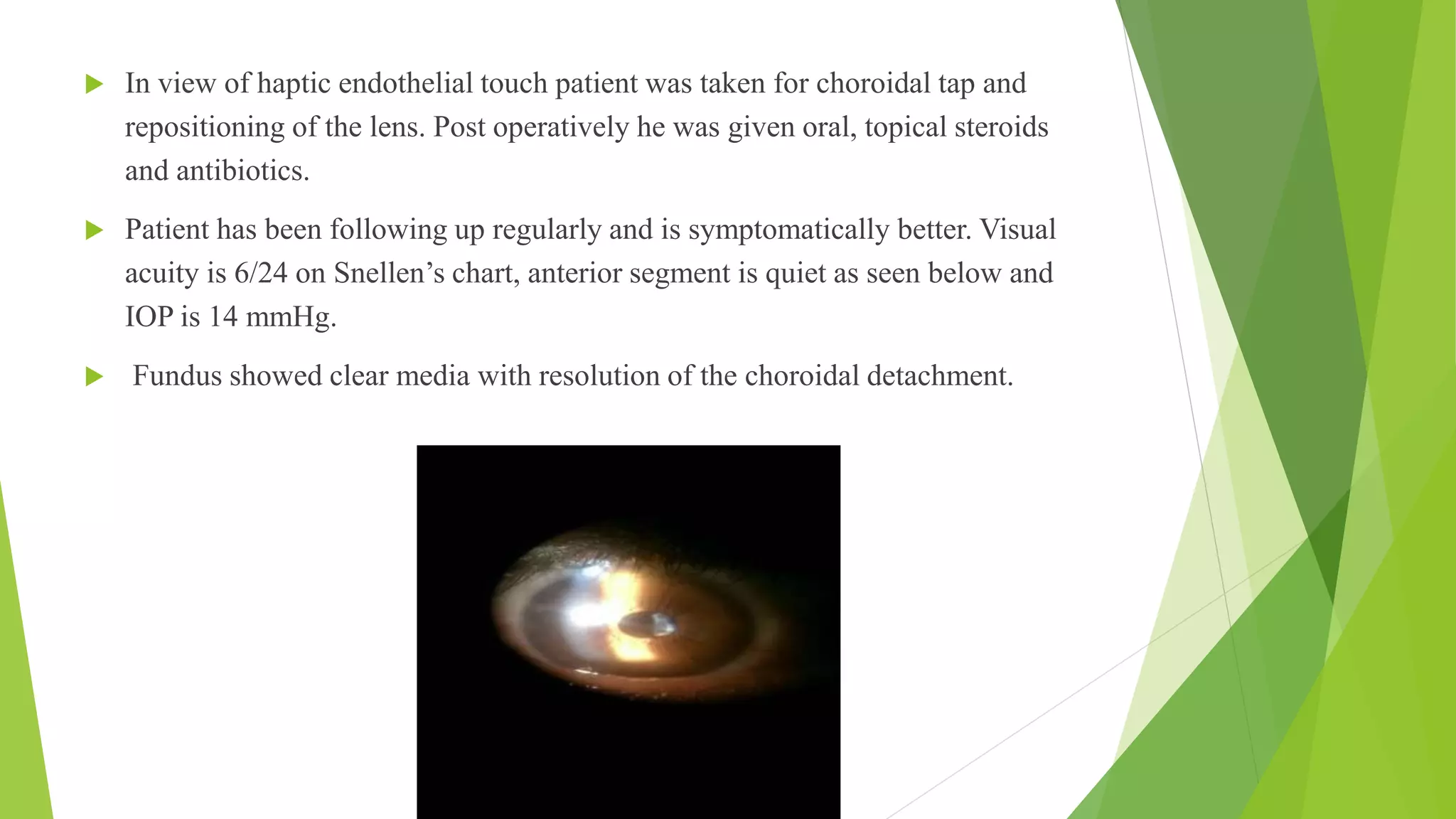 Severe Inflammation following intravitreal injection Ranibizumab ...