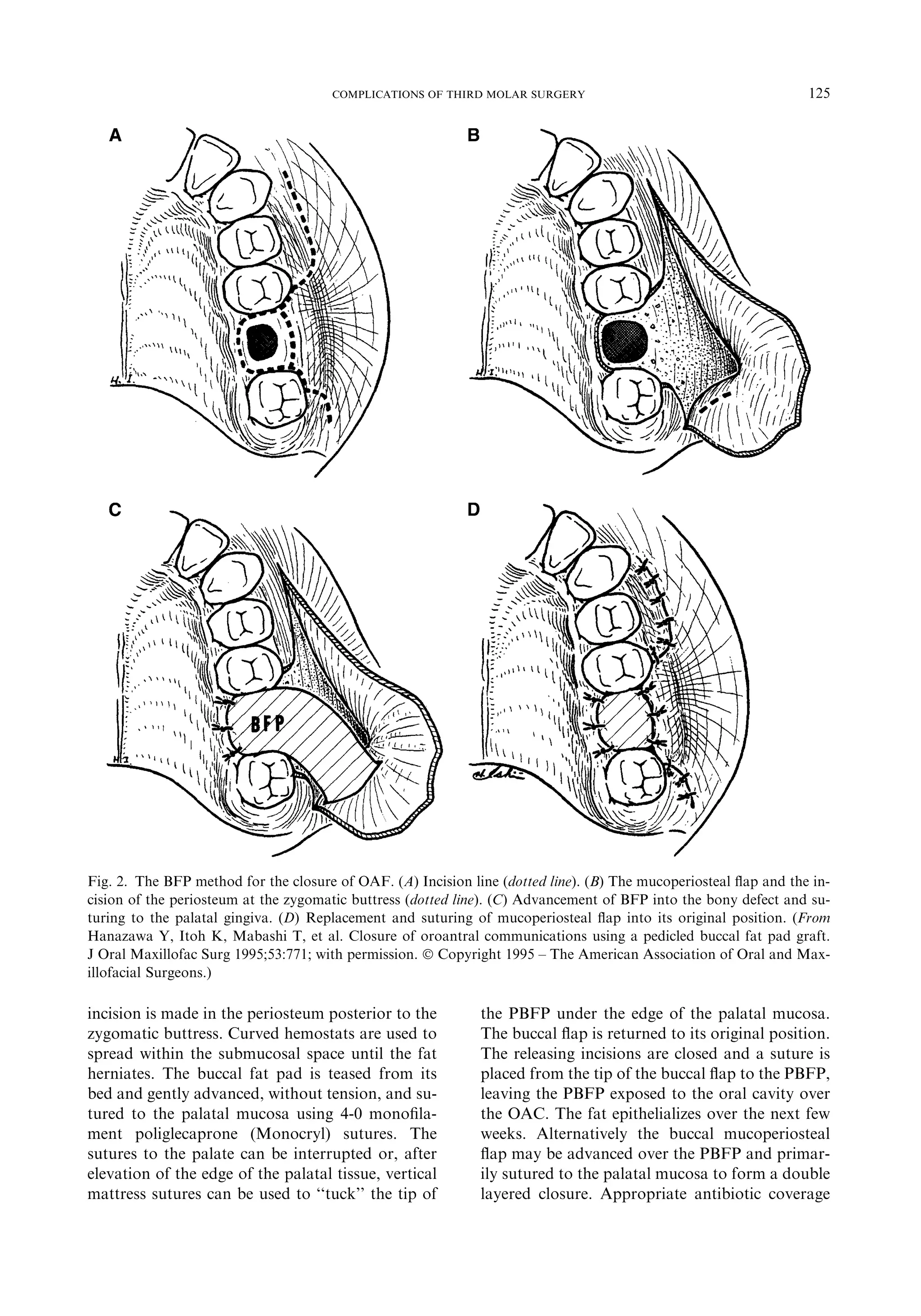 Complications of Third Molar Surgery | PDF