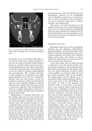 Complications of Third Molar Surgery | PDF