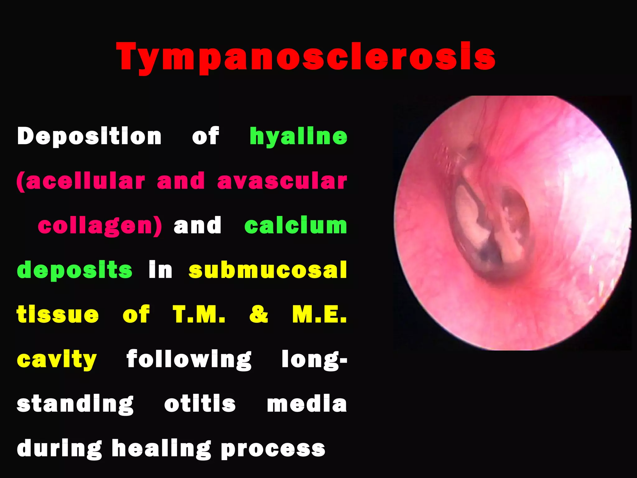Non suppurative otitis media | PPT