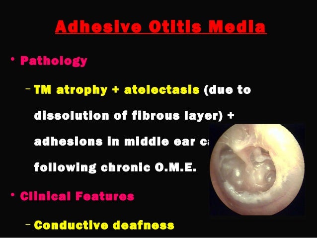 12. non suppurative otitis media