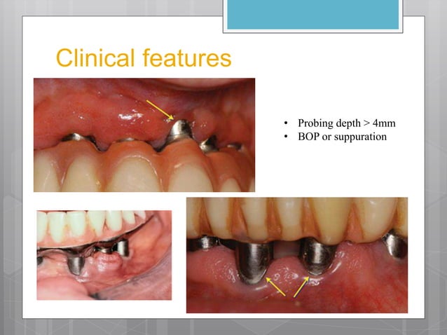 Peri implant Diseases and its management | PPTX | Bone and Joint Conditions | Diseases and ...