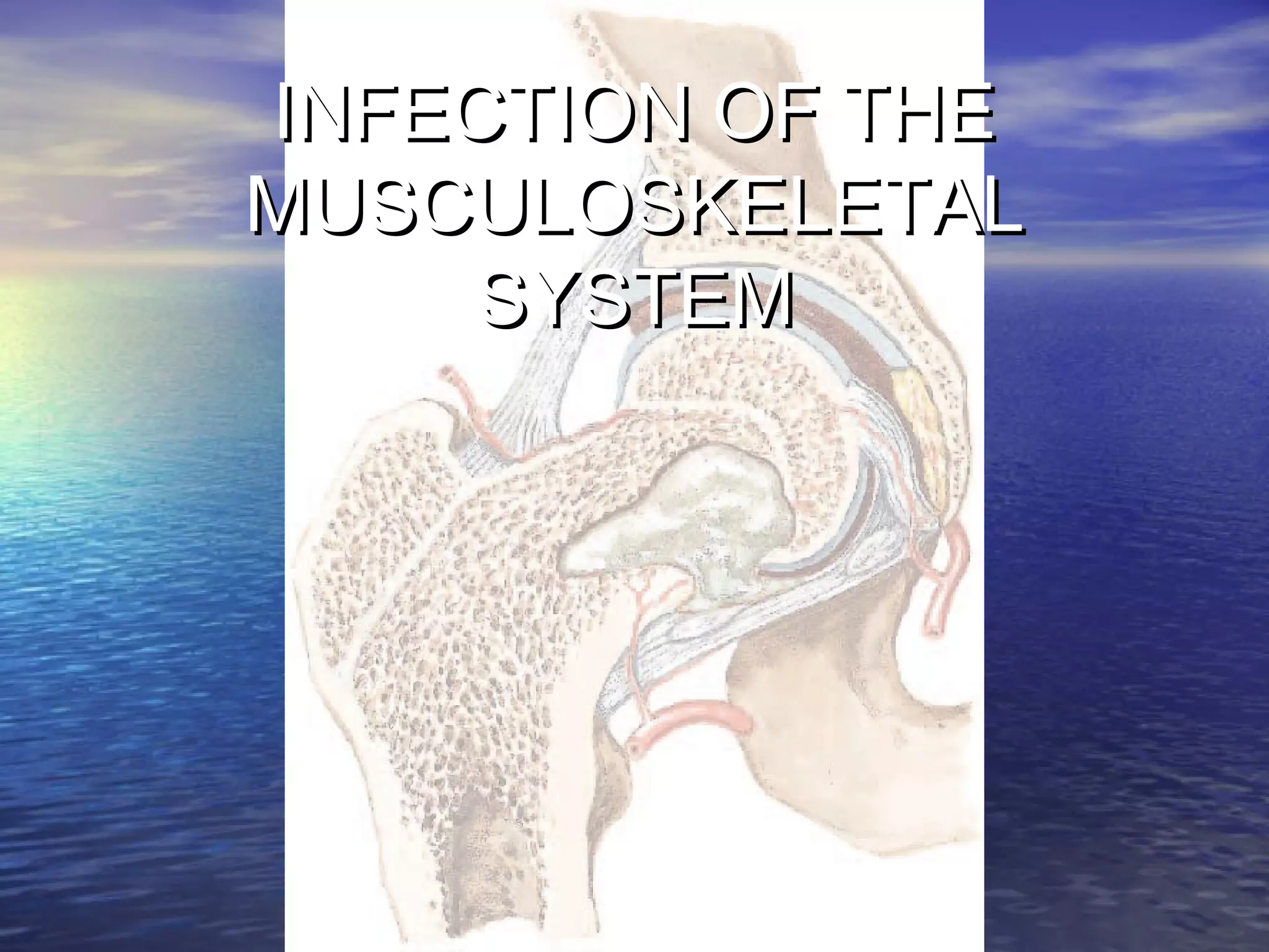 Infection of Musculoskeletal system | PPT