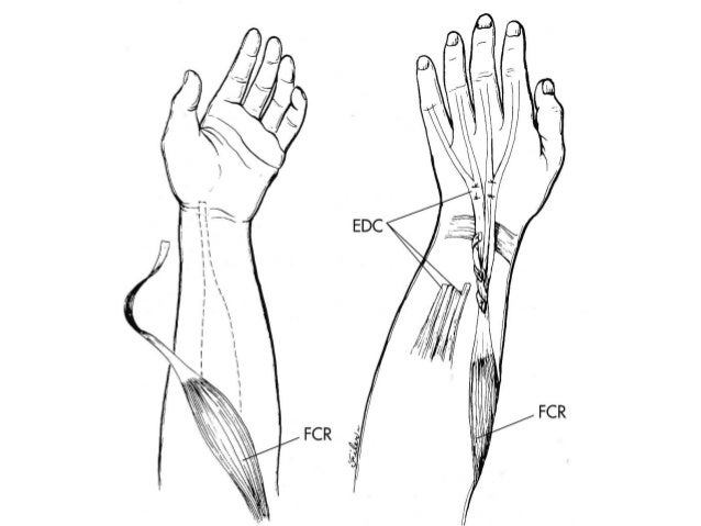 12. tendon transfers