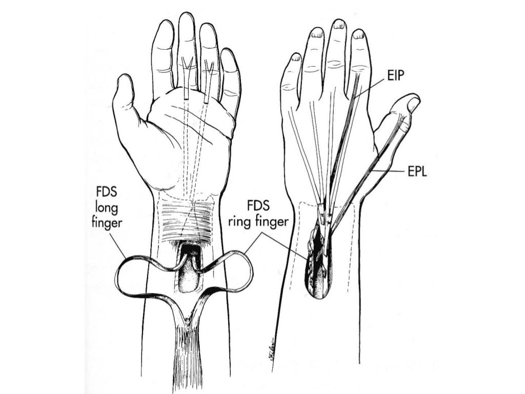 12. tendon transfers