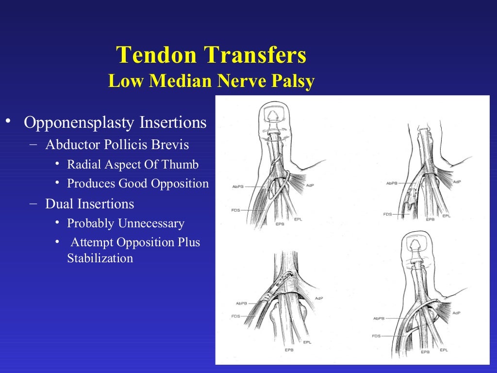 Upper Extremity Tendon Transfers: A Brief Review Of History ...