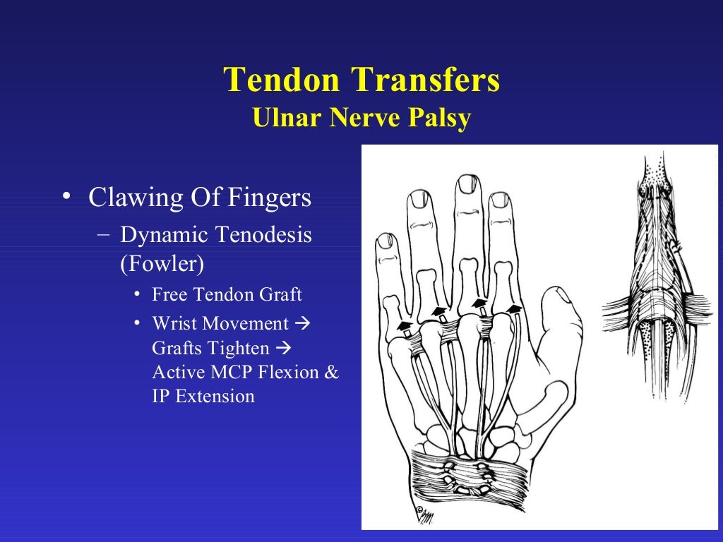 12. tendon transfers