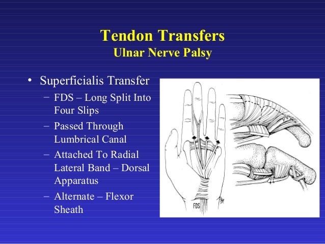 12. tendon transfers