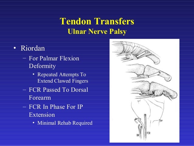 12. tendon transfers