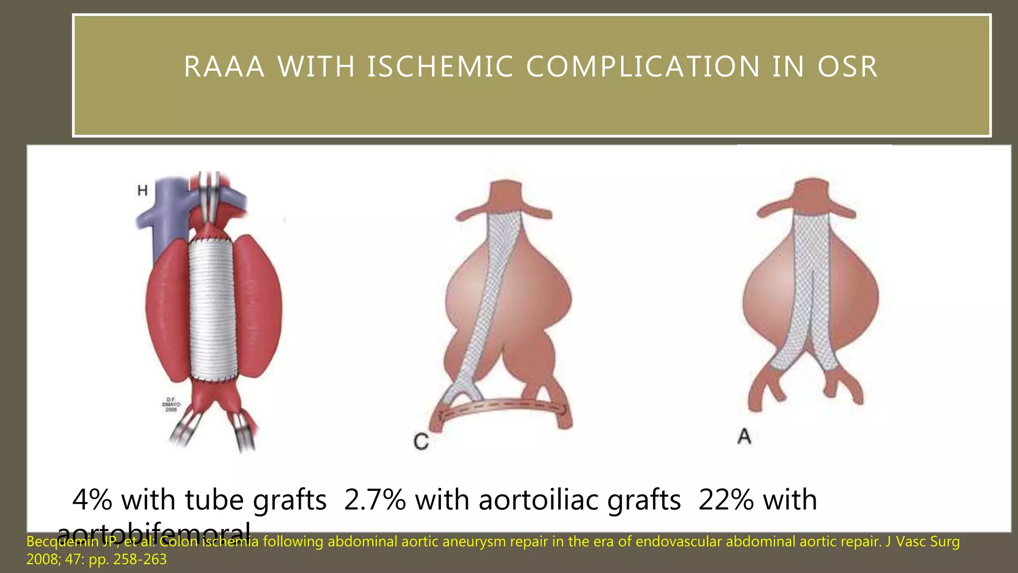 12.3.61 colonic ischemia in evar & open repair aaa | PPTX