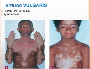 12. Vitiligo | PPTX