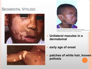 12. Vitiligo | PPTX