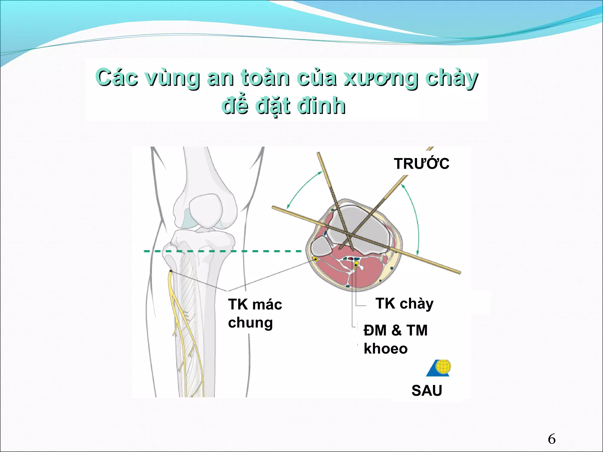 12. external fixation of tibial shaft v nese | PPT