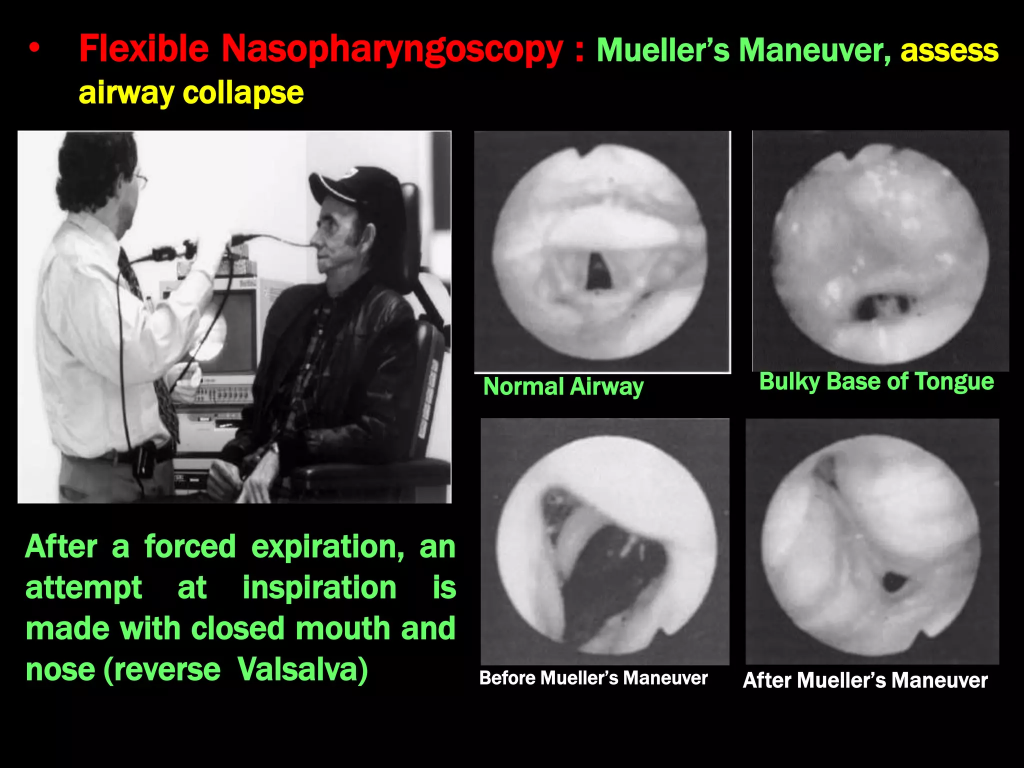 Obstructive sleep apnea syndrome (OSAS) | PPT