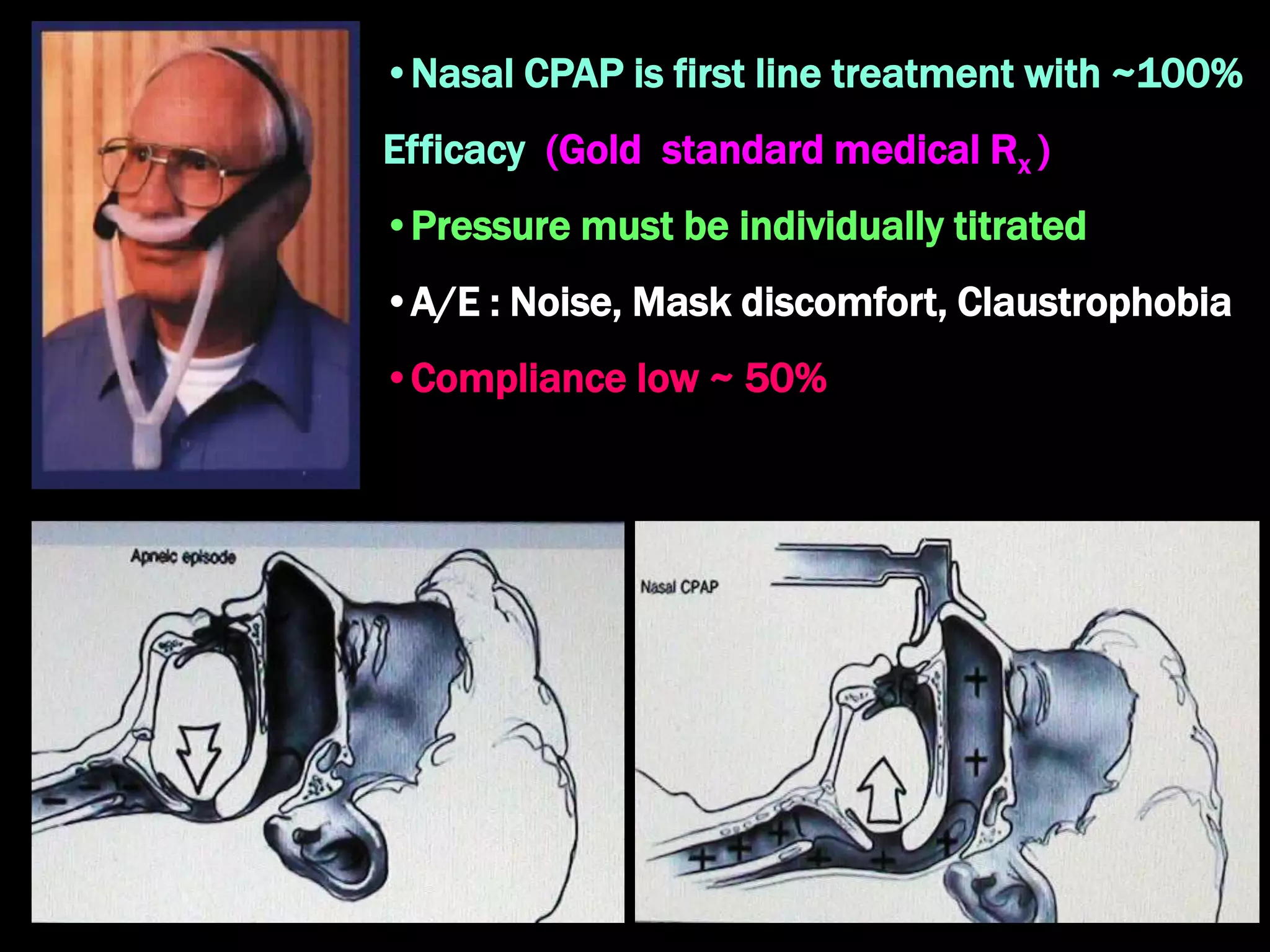 Obstructive sleep apnea syndrome (OSAS) | PPT