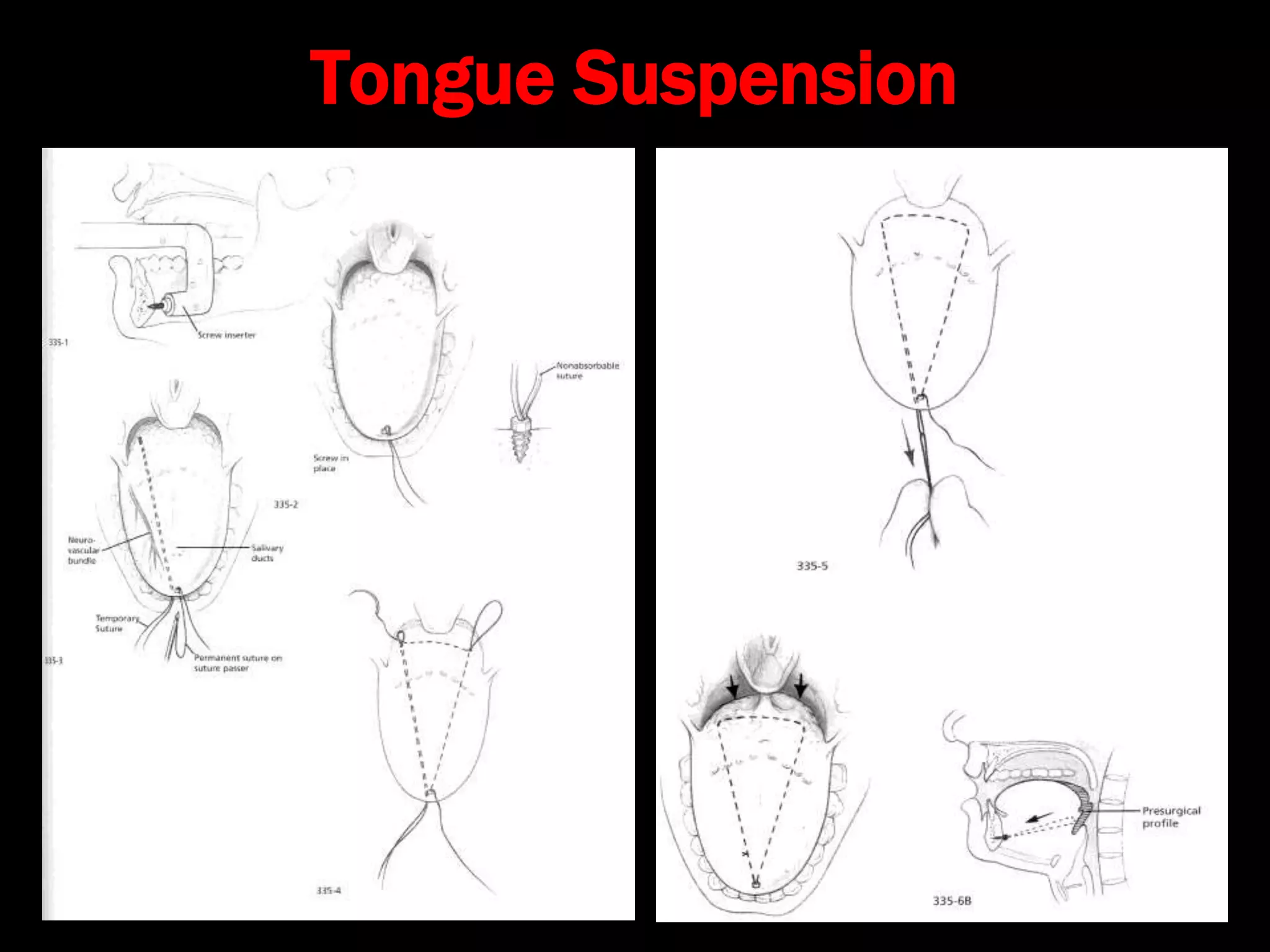 Obstructive Sleep Apnea Syndrome Osas Ppt