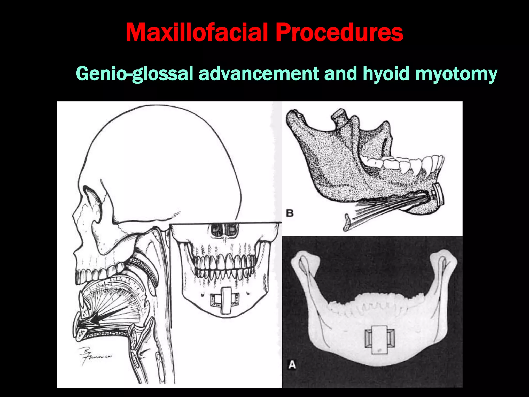 Obstructive sleep apnea syndrome (OSAS) | PPT