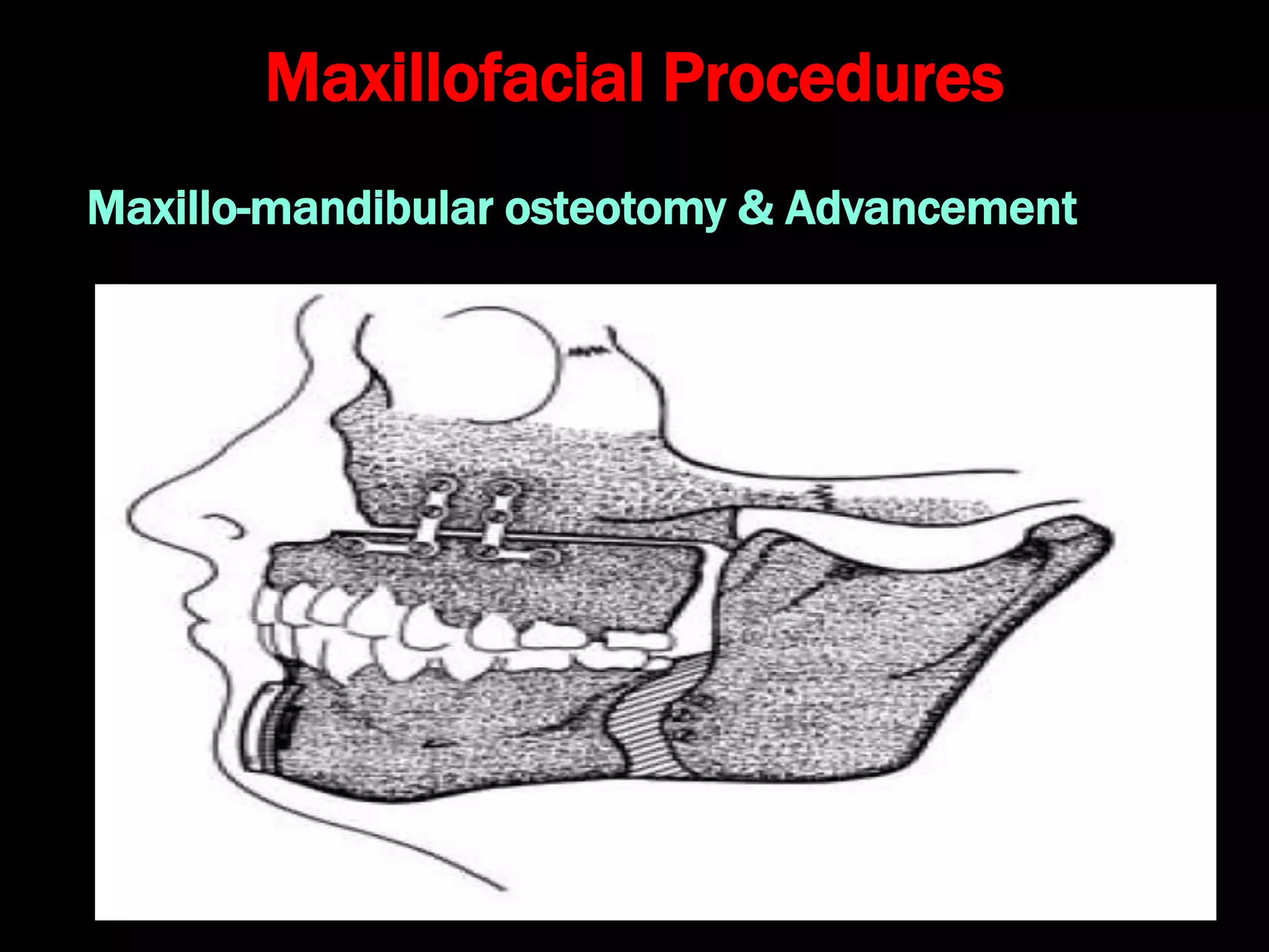 Obstructive sleep apnea syndrome (OSAS) | PPT