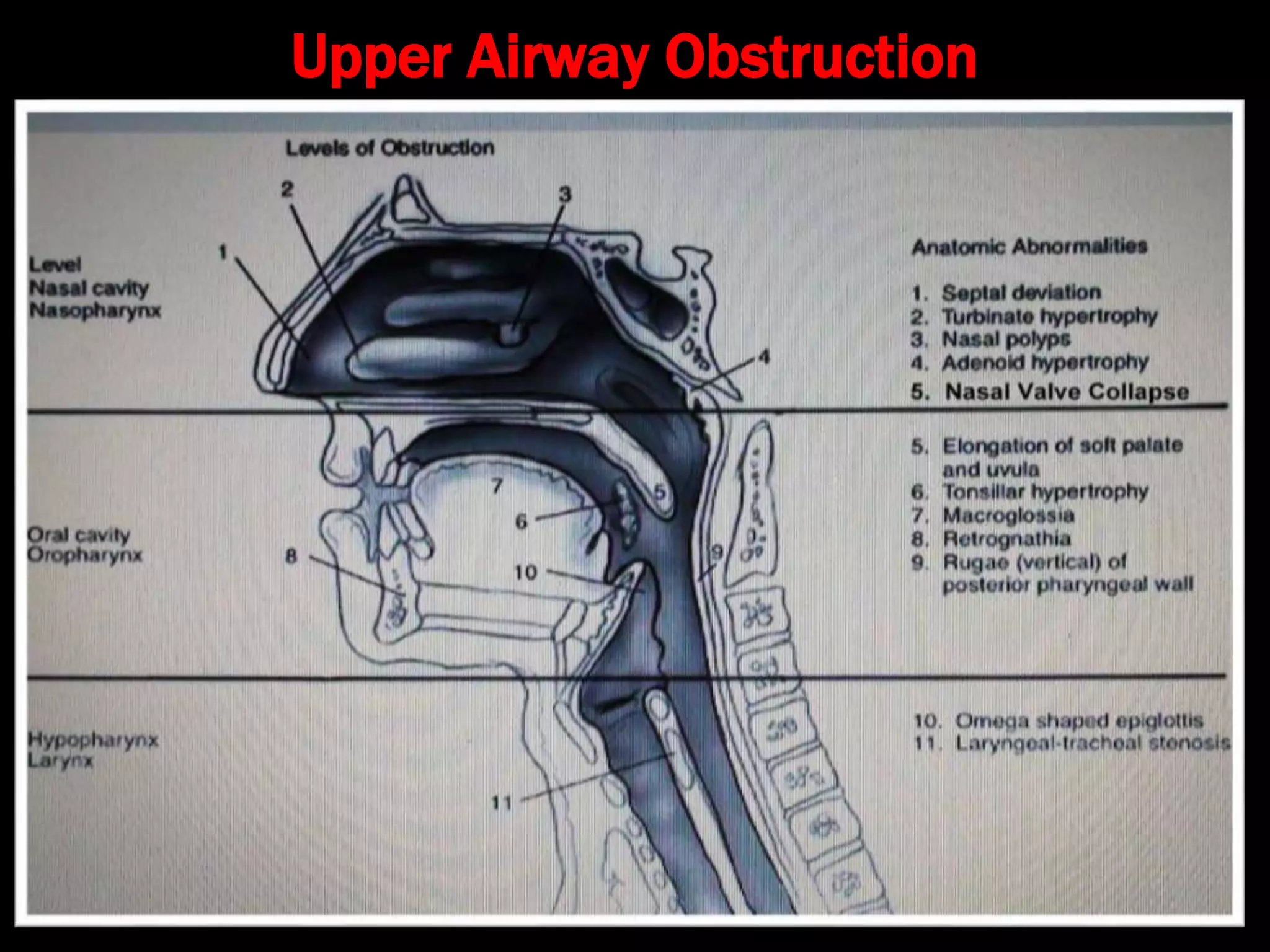 Obstructive sleep apnea syndrome (OSAS) | PPT