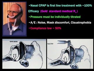 Obstructive sleep apnea syndrome (OSAS) | PPT