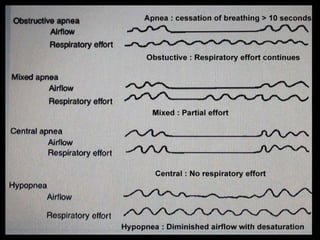 Obstructive sleep apnea syndrome (OSAS) | PPT