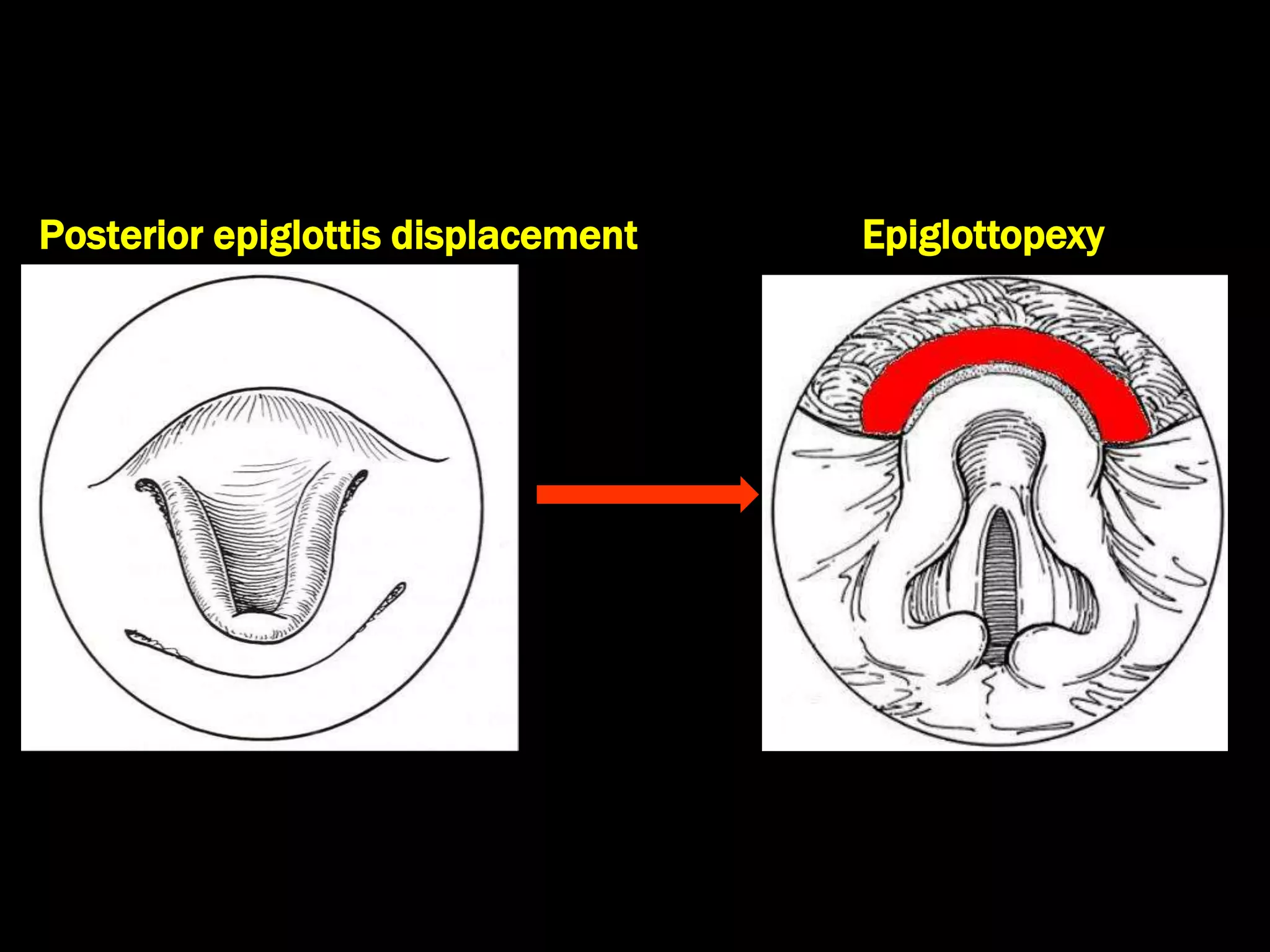 Congenital lesions of larynx and evaluation of stridor | PPT