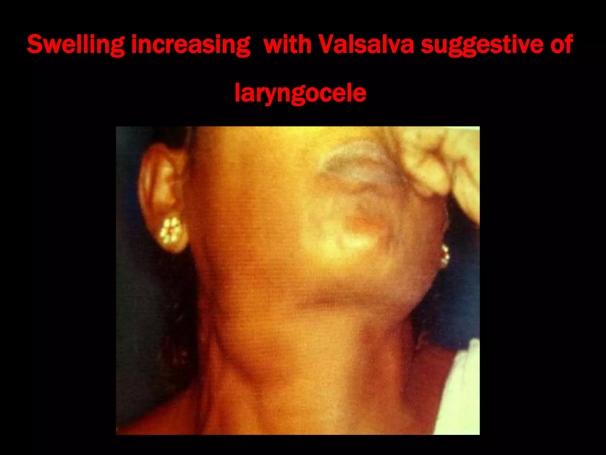 Congenital lesions of larynx and evaluation of stridor | PPT