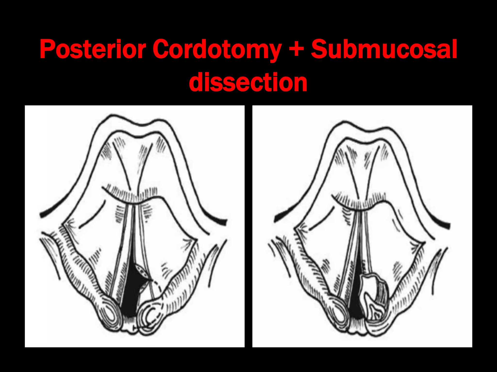 Congenital lesions of larynx and evaluation of stridor | PPT