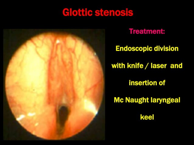 Congenital lesions of larynx and evaluation of stridor | PPT