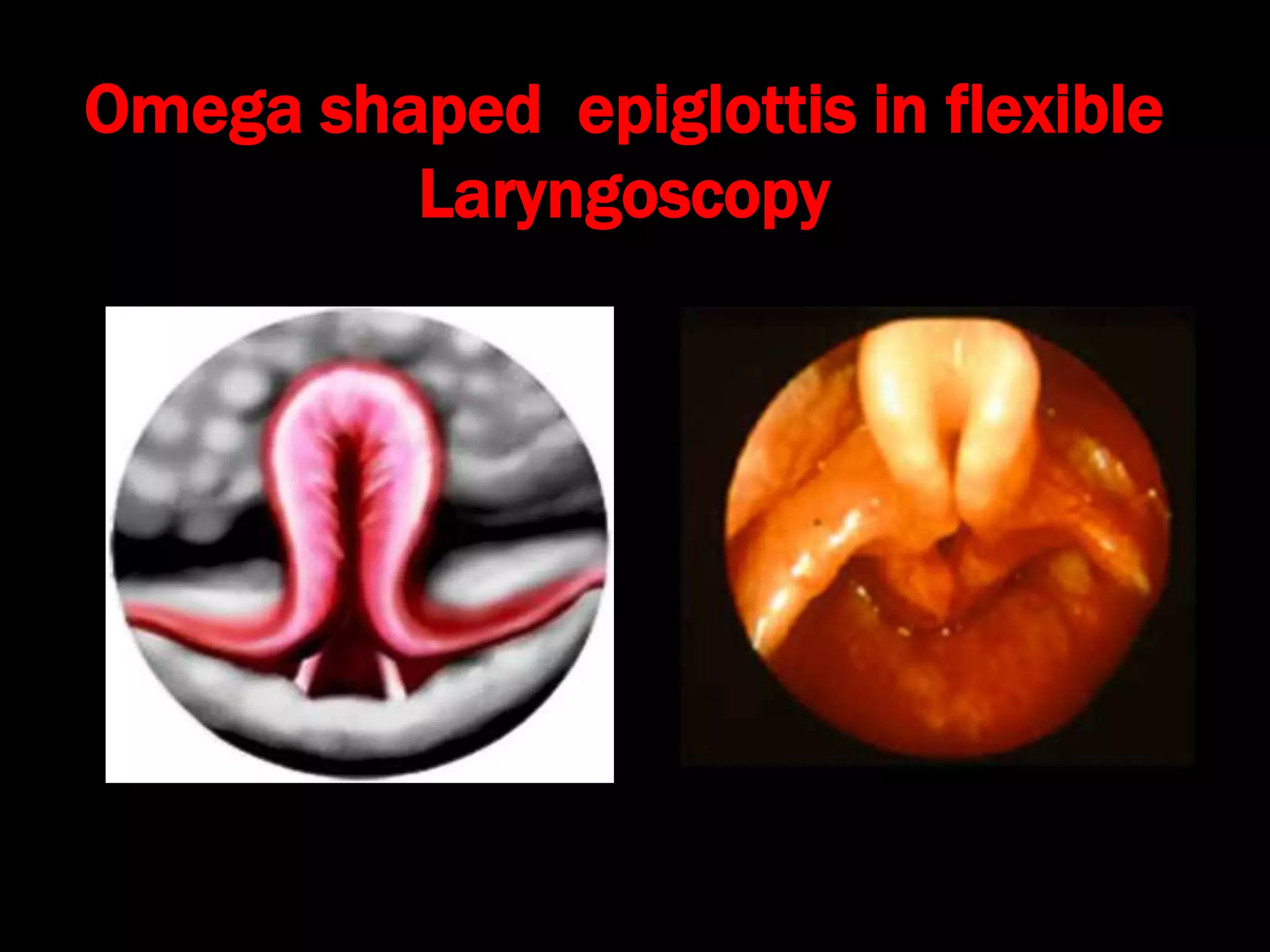 Congenital lesions of larynx and evaluation of stridor | PPT