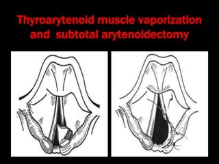 Congenital lesions of larynx and evaluation of stridor | PPT