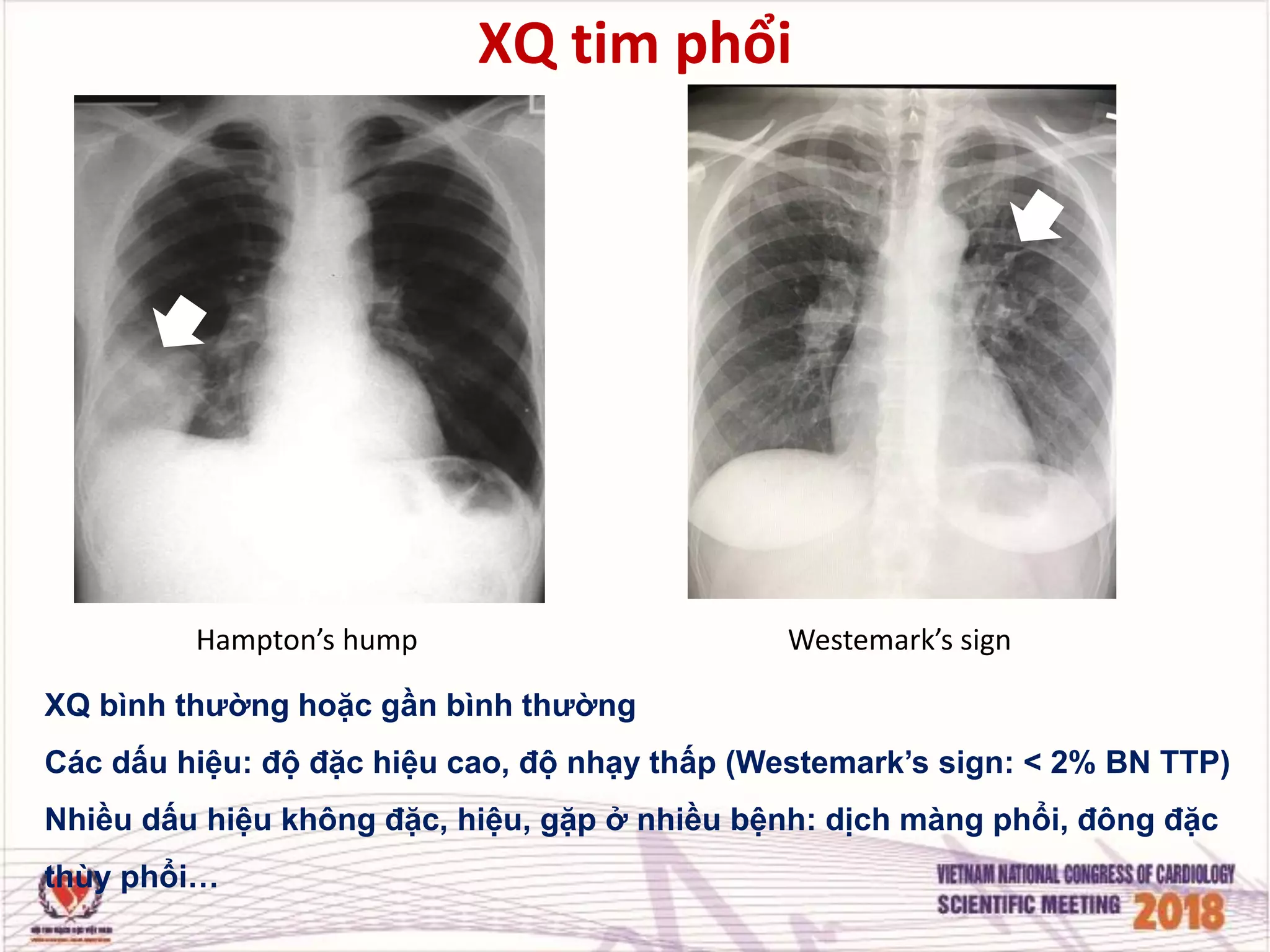 thuyên tắc động mạch phổi cấp - chẩn đoán - phân tầng nguy cơ | PDF