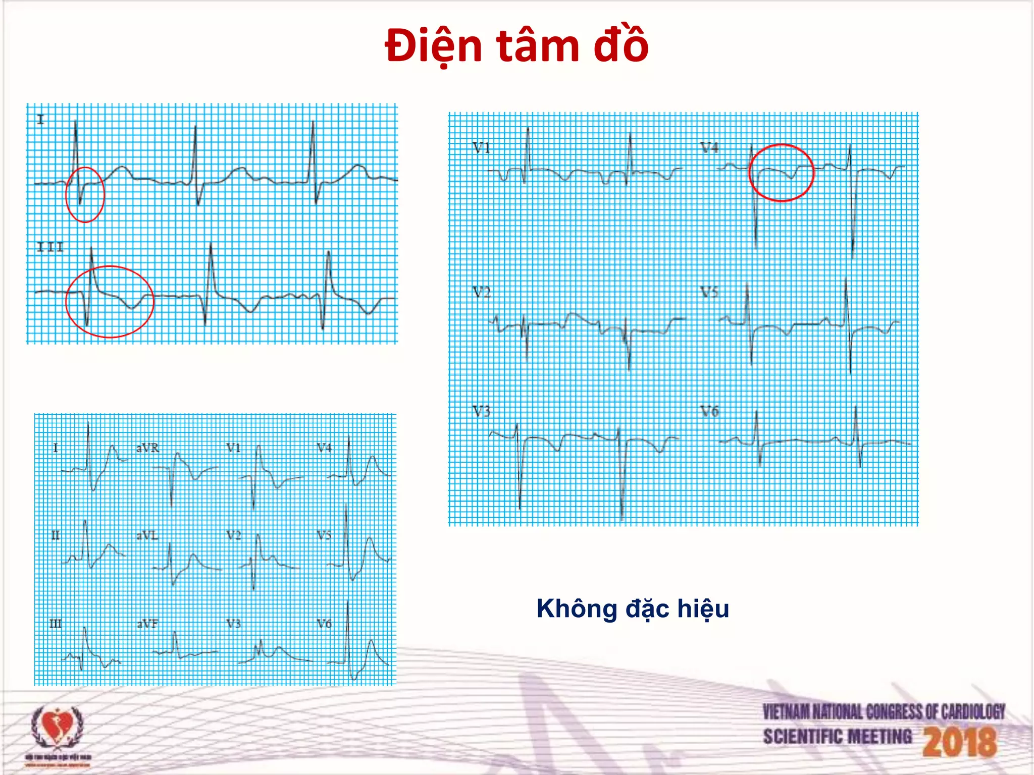 thuyên tắc động mạch phổi cấp - chẩn đoán - phân tầng nguy cơ | PDF