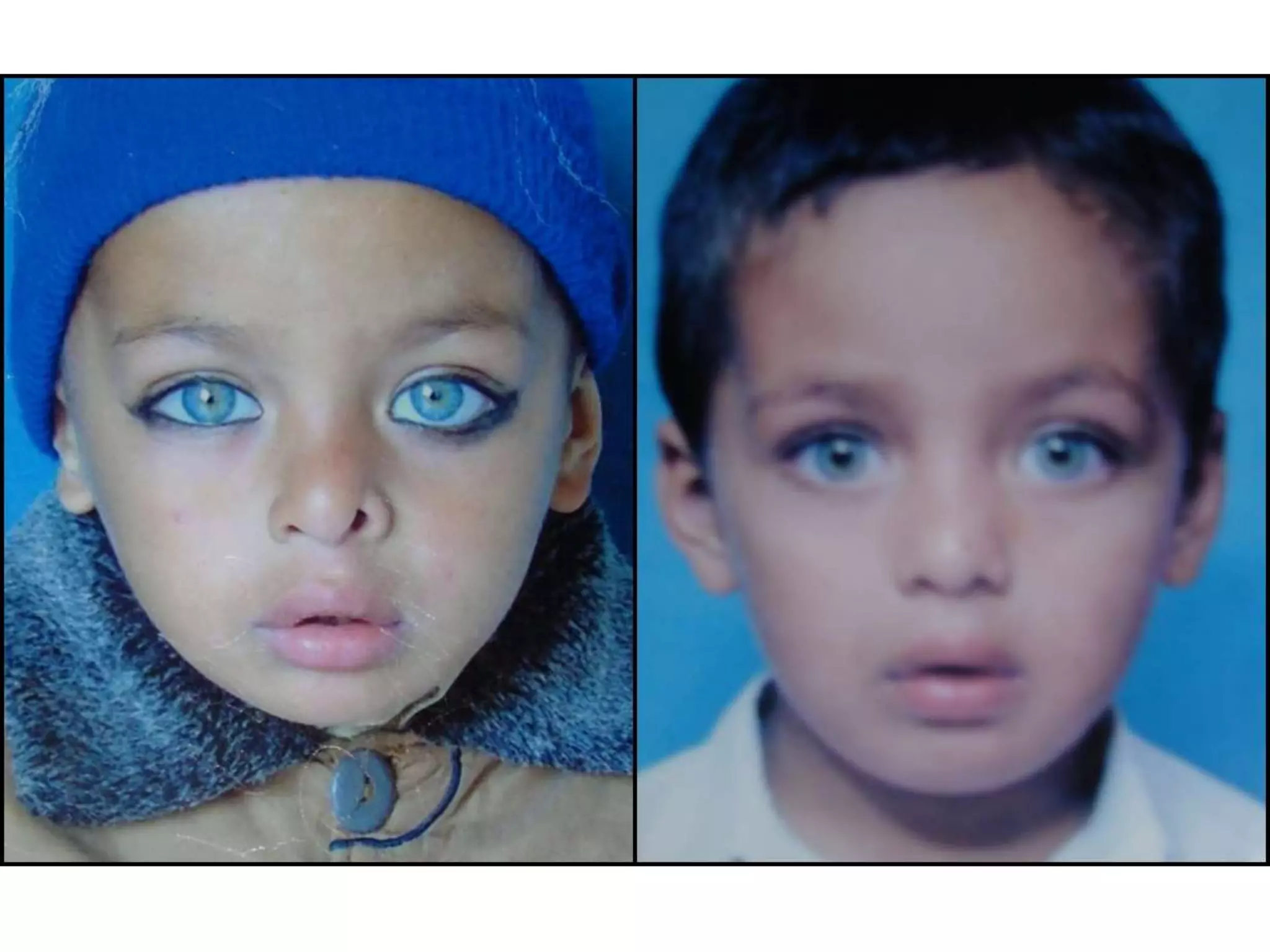 Craniofacial soft tissue reconstruction | PPT