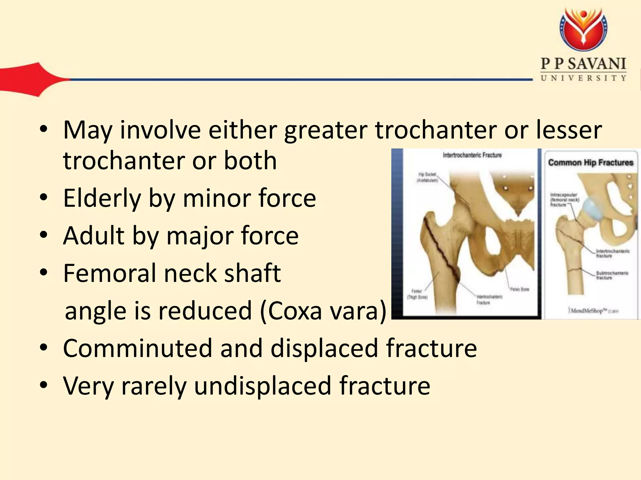 12. Inter trochanteric fracture | PPTX