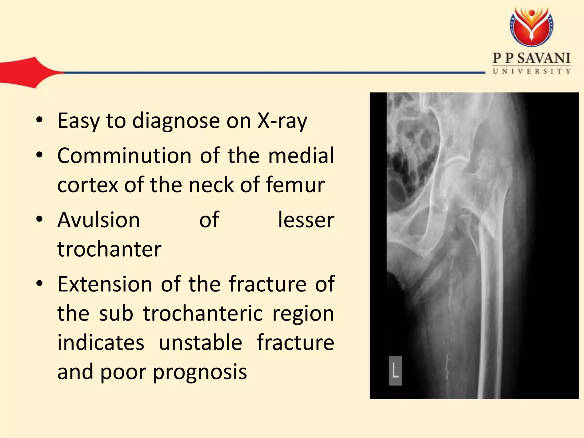 12. Inter trochanteric fracture | PPTX