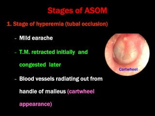 12. acute suppurative otitis media and and cortical mastoidectomy kk | PPT